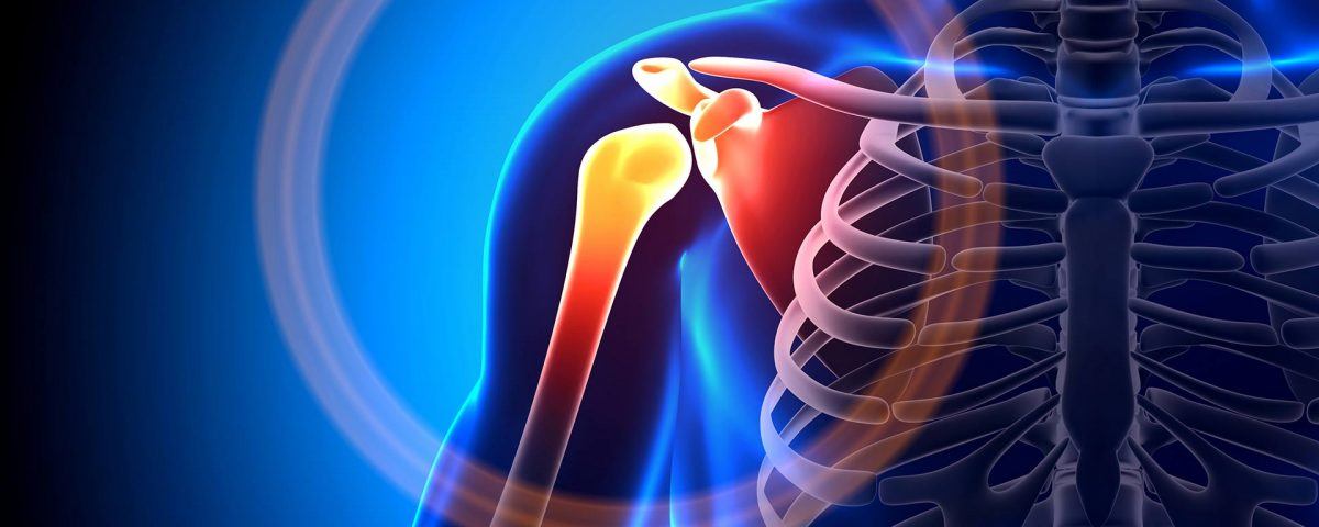 ΣΥΝΔΡΟΜΟ ΥΠΑΚΡΩΜΙΑΚΗΣ ΠΡΟΣΤΡΙΒΗΣ ΤΟΥ ΩΜΟΥ(SUBACROMIAL IMPINGEMENT ...