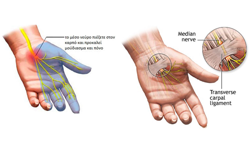 Σύνδρομο καρπιαίου σωλήνα (carpal tunnel syndrome) | Φυσικοθεραπεία ...